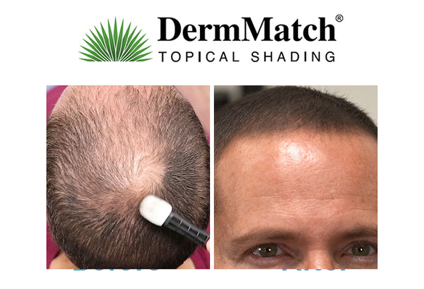 DermMatch UK | Hair Problem Solvers