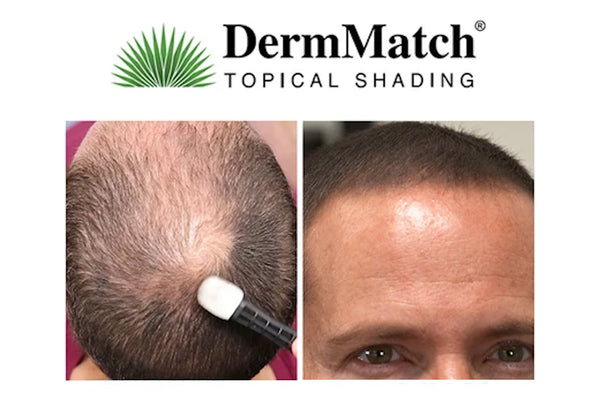 Solving Problem Hair – DermMatch UK