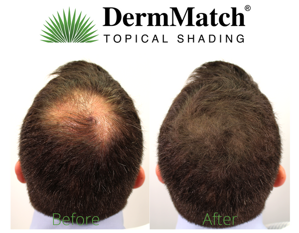 DermMatch UK | Can Protein be a cause for hair loss?